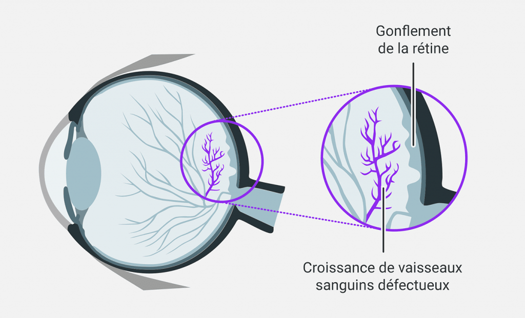 Dégénérescence maculaire liée à l’âge (DMLA) – Traiter - Fokus Mensch
